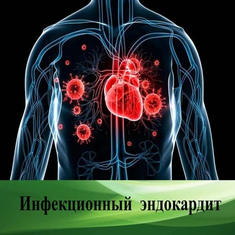 Infektsionny endokardit | PPTX | Heart and Cardiovascular Diseases ...