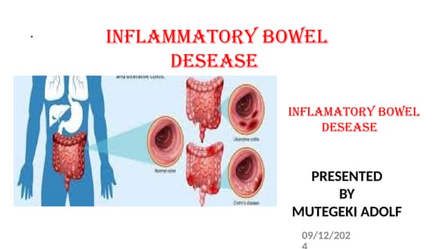 Crohn's disease | PPTX