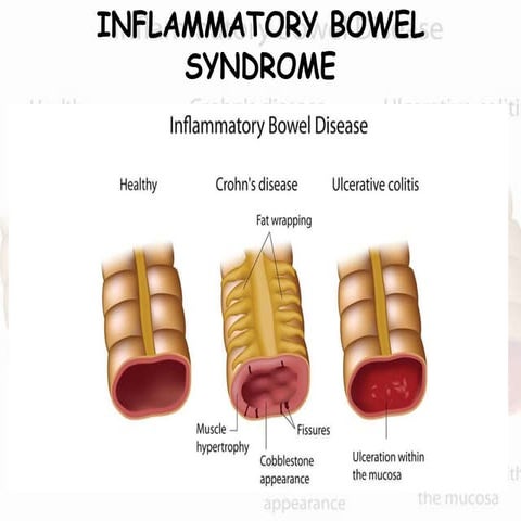 Pathophysiology of Inflammatory Bowel Disease.pptx