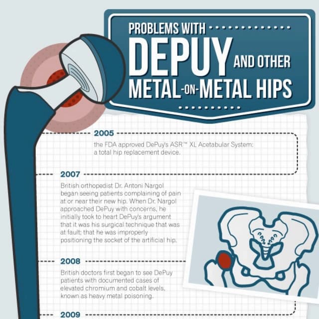 Metal Hip Infographic: Problems With DePuy & Other Metal-On-Metal Hips ...