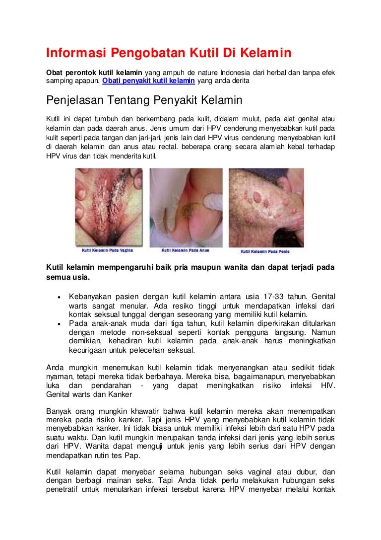 Informasi pengobatan kutil di kelamin
