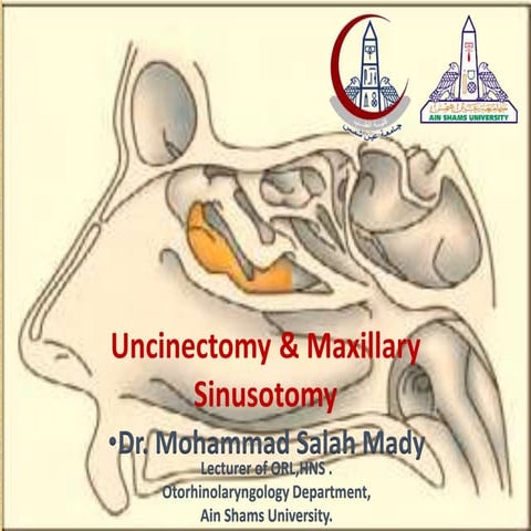 Infundibulotomy & Maxillary sinusotomy pg | PPT