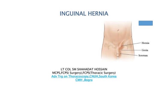 Anatomia Do Canal Inguinal Ppt The Cyst Of The Canal Of Nuck: Anatomy,