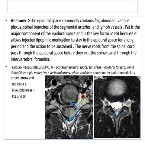 Injection in spine | PPTX