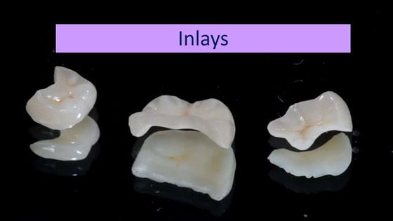 Vonlay; A paradigm shift in post endodontic restoration: A case report ...