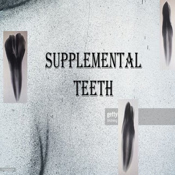 INTEGRATED SUPERNUMERARY TEETH power point presentation | PPTX