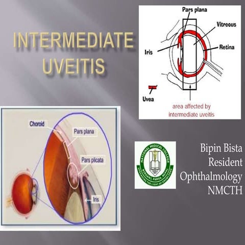 Intermediate uveitis | PPTX | Eye and Vision Conditions | Diseases and Conditions