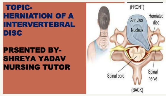 Intervertebral Disc Prolapse L4 L5 Disc Bulge & Disc Herniation Dr.