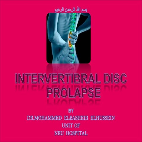 Intervertebral disc prolapse(ivdp) | PPTX
