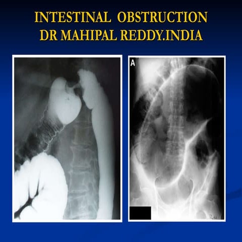 Intestinal Obstruction .DR MAHIPAL., INDIA | PPT