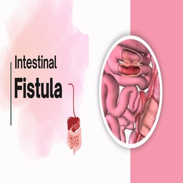 Intestinal Fistula.pdf health allied.com