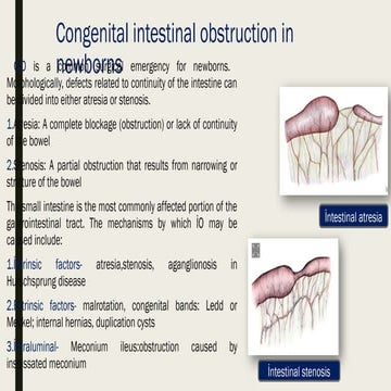 New born intestinal obstraction surgery.pptx