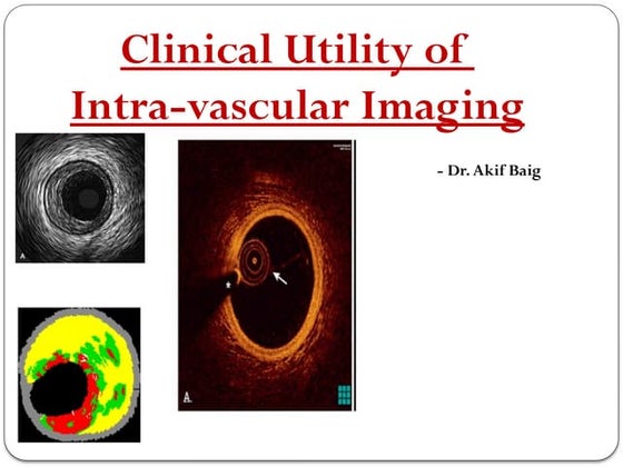 Intravascular Ultrasound (IVUS) | PPTX | Heart and Cardiovascular ...