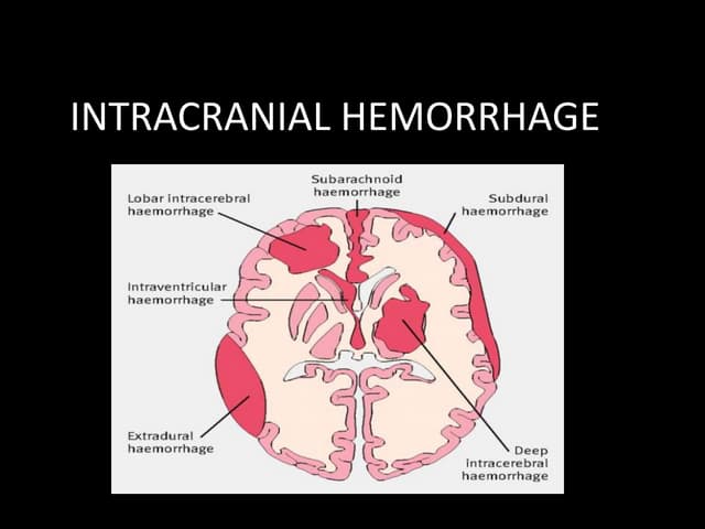 Subarachnoid Hemorrhage Vs Intracerebral Hemorrhage