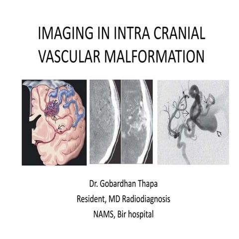 Intracranial Vascular Malformations Pptx
