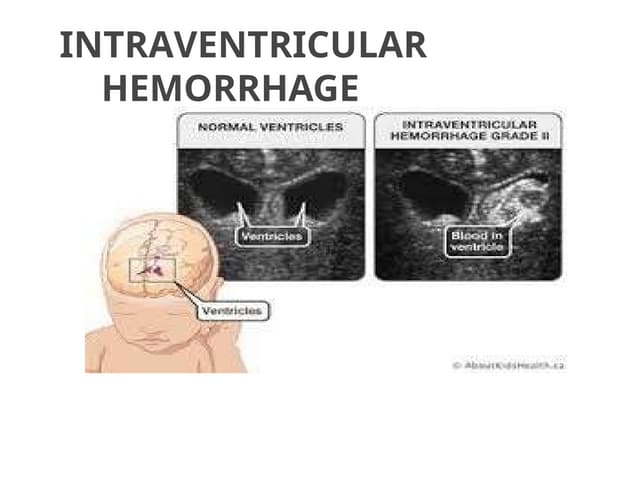 Intraventricular Hemorrhage in pediatrics | PDF
