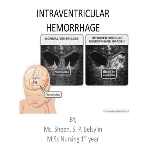 Intraventricular Hemorrhage Grades The Radiology Assistant : Neonatal