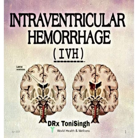 Intraventricular hemorrhage | PDF | Death, Injury, or Military Conflict ...