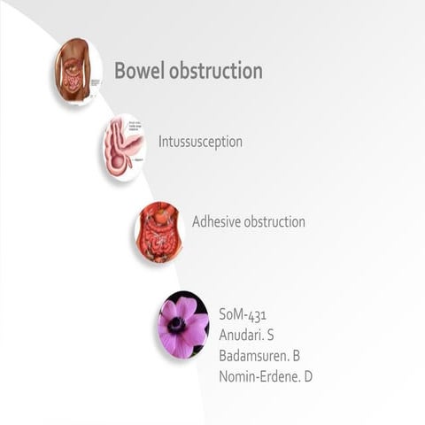 Intussusception | PPTX