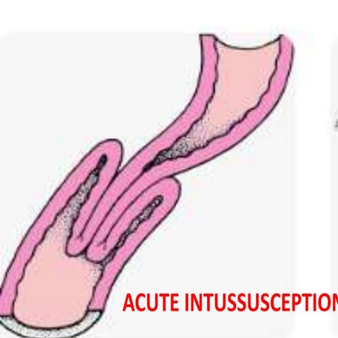 INTUSSUSCEPTION.pptx