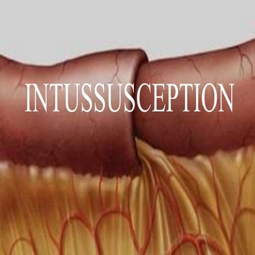 intussusception.pptx | Digestive Disorders | Diseases and Conditions