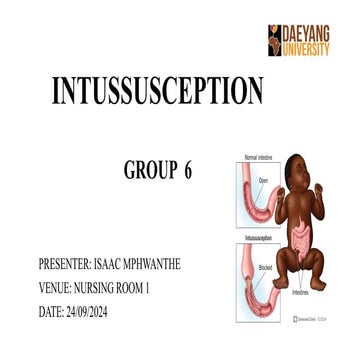 Nursing management of children with intussusception | PPTX