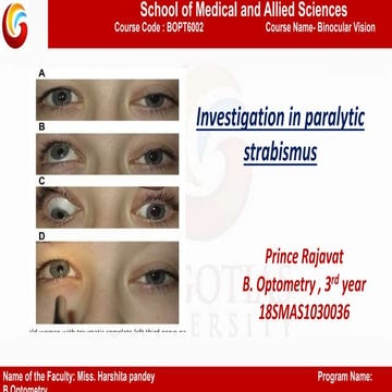 Investigation in paralytic strabismus | PPT