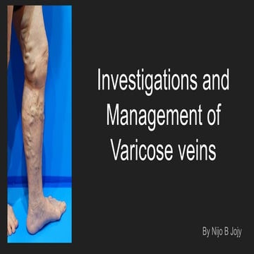 Investigations and Management of Varicose veins.pdf