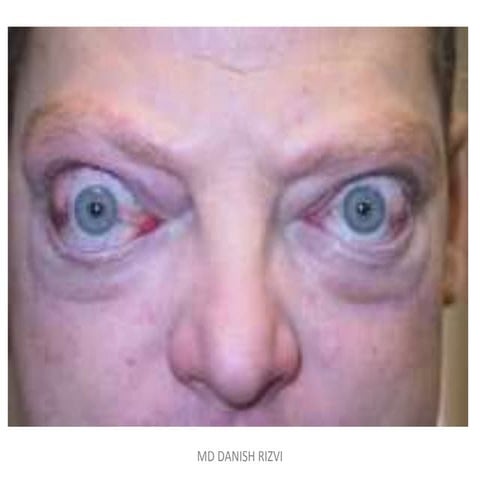 Iodine def | PPTX