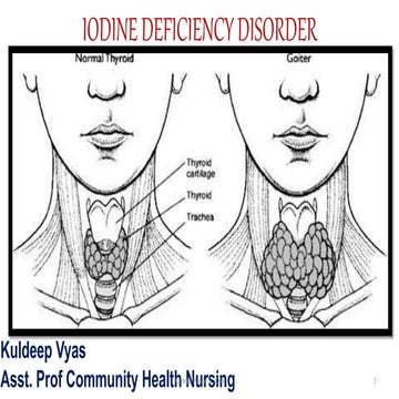 Iodine Deficiency Disorder