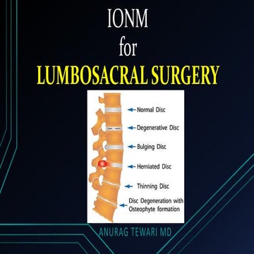 IONM for Lumbosacral Surgery | PPTX