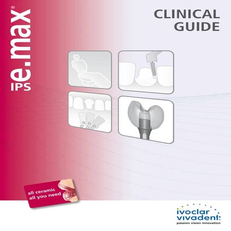 Ips+e max+clinical+guide | PDF