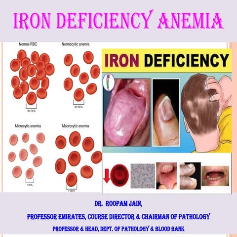 IRON DEFICIENCY ANAEMIA, P/S, S/S, DIAGNOSIS, TREATMENT | PPTX