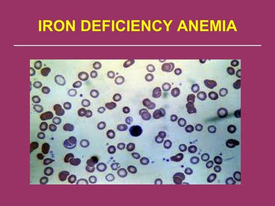 Iron Deficiency Anemia (IDA) | PPTX | Blood Disorders | Diseases and ...