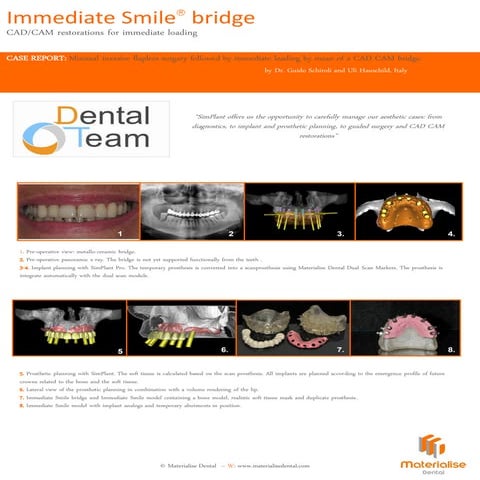 Immediate Smile bridge: Minimal invasive flapless surgery followed by immediate loading by Dr ...