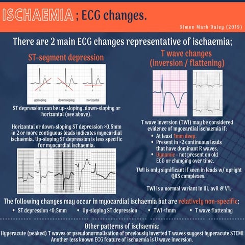 Non-Specific Intra-Ventricular Conduction Delay - A quick-lit-review | PDF