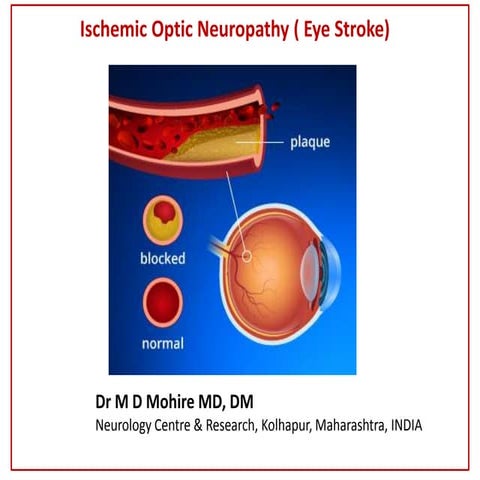 Ischemic of optic neuropathy, Optic Neuropathy (Ischemic), Eye Stroke ...