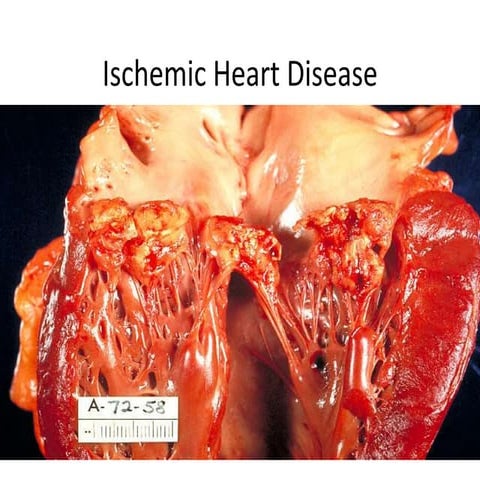 Ischemic heart disease | PPTX