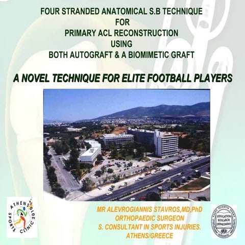 ACL Reconstruction using JewelAcl graft | PPT