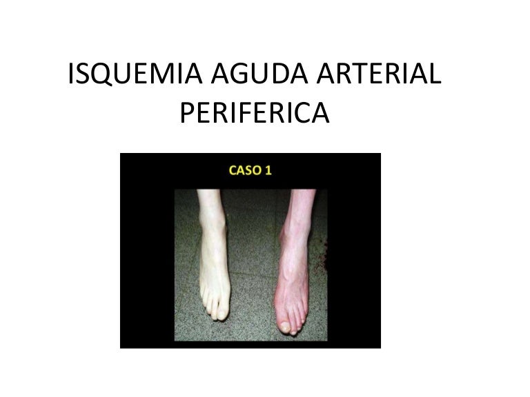 Isquemia aguda arterial periferica