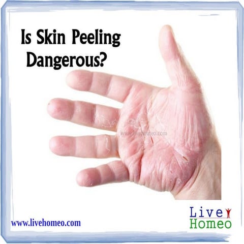 Is skin peeling dangerous | PPT
