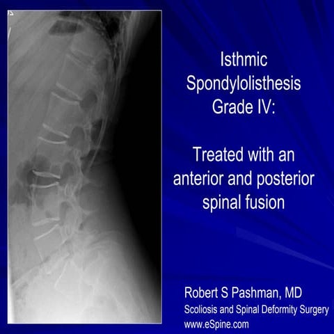Case Review #1: 16 year old with Isthmic Spondylolisthesis Grade IV | PDF