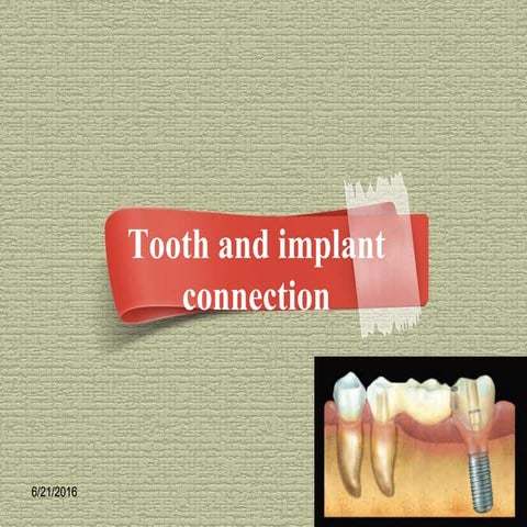 Implant tooth connection | PPTX