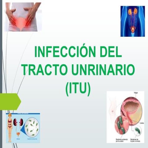 neumonia e itu.pptx