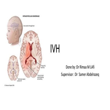 Intraventricular Hemorrhage