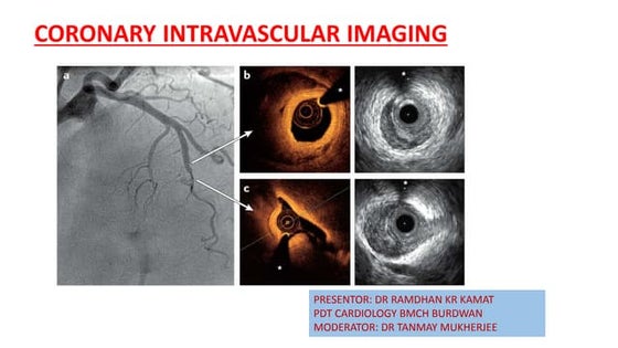 Intravascular Ultrasound (IVUS) | PPT