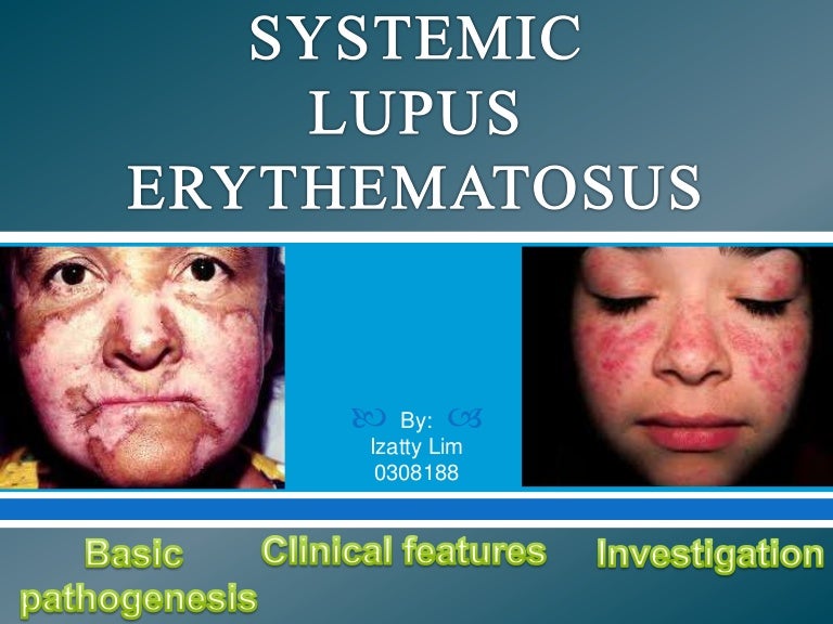 Systemic Lupus Erythematosus