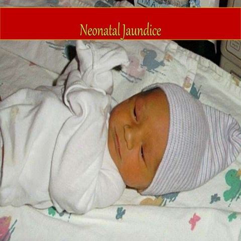 neonatal Jaundice | PPTX