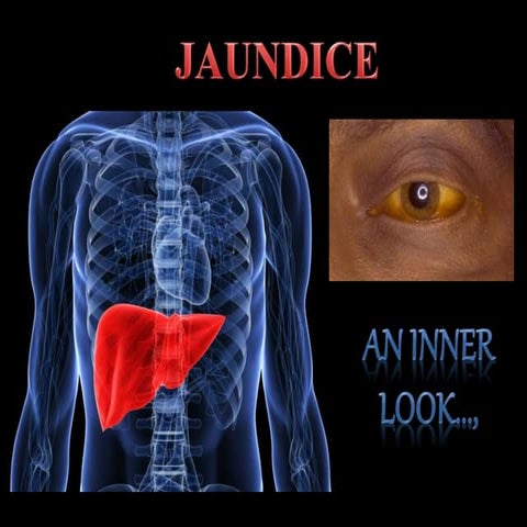 power point tentang hiperbilirunemiapptx | PPTX