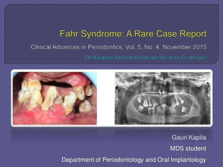 Fahr Syndrome- A Rare Case Report Fahr Syndrome- A Rare Case Report